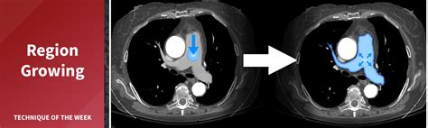 Region Growing 3d And Quantitative Imaging Laboratory