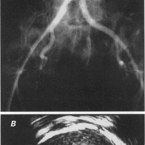 A And B Recurrence Of Distal Embolic Symptoms Occurred 67 Months After Download Scientific