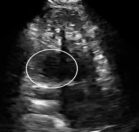 Echocardiogram Normal And Abnormal Findings