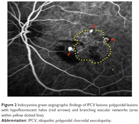 Idiopathic Polypoidal Choroidal Vasculopathy In Thai Patients With Cli