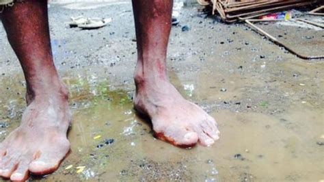 Leptospirosis Cases In India At Jeff Updike Blog