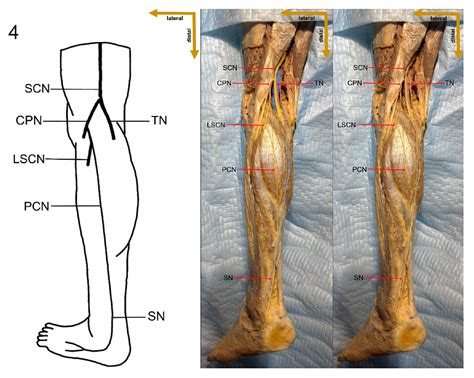 Anatomical Variations In The Formation Of The Sural Nerve A Pilot