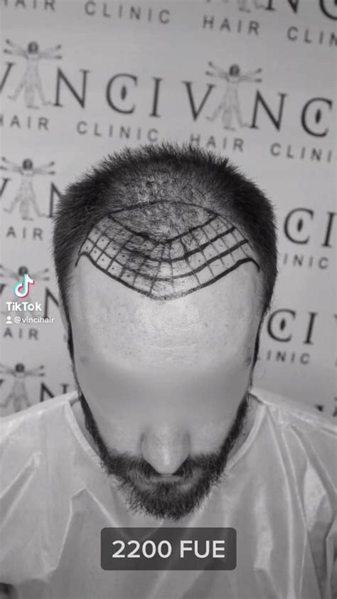 Hair Transplant Turkey Istanbul Estepera Hair Clinic Artofit