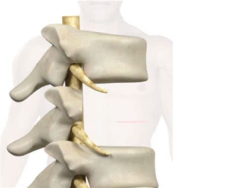 Vertebral Body Replacement Igea Brain Spine Pain And Orthopedics