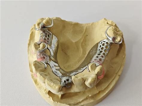 China China Dental Lab Metal Framework With Valplast Clasp