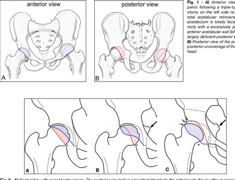 Figure 1 From Total Acetabular Retroversion Following Pelvic Osteotomy Presentation Management