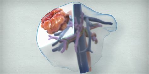 Segment Vii Partial Segment Viii Liver Resection Tvasurg The Toronto Video Atlas Of Surgery