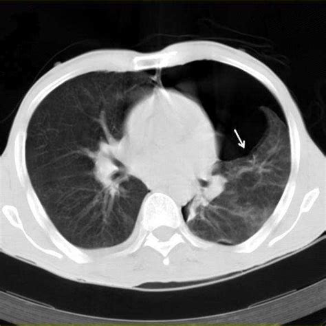 Chest Ct Scan Uncovered A Tension Pneumothorax Download Scientific Diagram