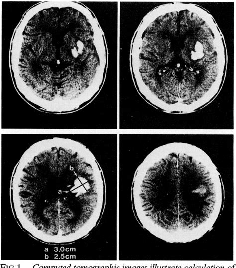 Hyperglycemic Hyperosmolar Nonketotic Coma Semantic Scholar
