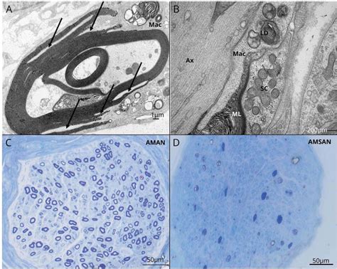 Main Pathologic Findings In Acute Polyradiculoneuropathy Personal