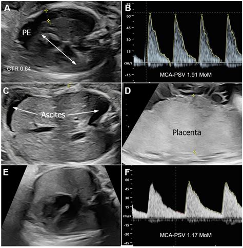 Is Hydrops Fetalis Fatal