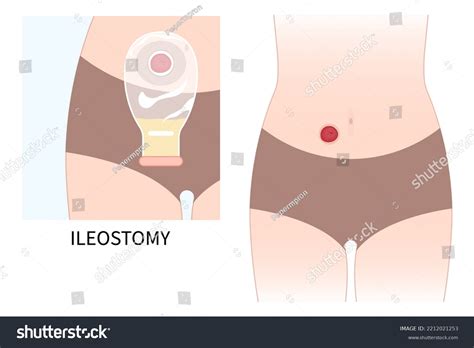 Loop Ileostomy J Pouch