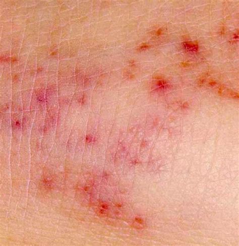 Cause Of Skin Rash In Adults At Nicholas Erwin Blog