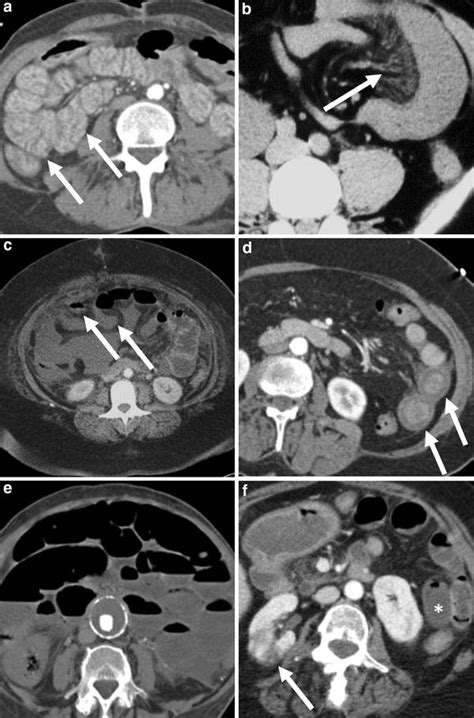 Findings Of Acute Mesenteric Ischemia On Contrast Enhanced Ct Images A Download Scientific