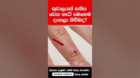 තුවාලයක් සනීප වෙන්නේ මෙන්න මෙහෙමයි Youtube