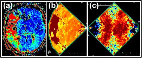 Parameter Maps Of Perfusion Imaging In Patient 8 Occlusion Of M1