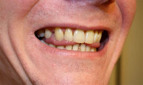 Routine Premolar Extraction As Part Of Orthodontic Treatment May Impact Mandibular Kinematics