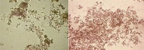 Urine Has Amorphous Urates Whats The Matter Med