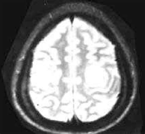 Mri Brain Showing Bilateral Frontal Convexity Space Occupying Lesions Download Scientific