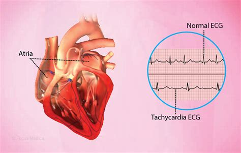 Alcohol And Vagal Tone As Triggers For Paroxysmal Atrial Fibrillation