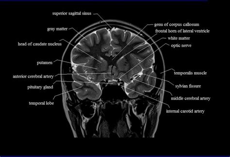Sylvian Fissure Mri Anatomy