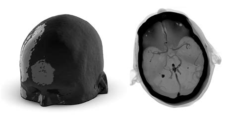 Unlocking The Future Of Brain Aneurysm Diagnosis Phantomx