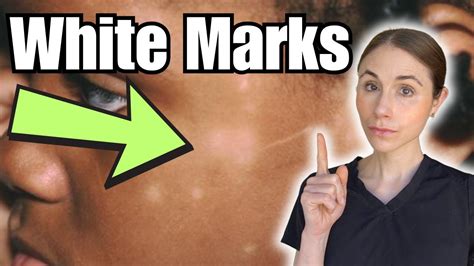 White Marks On The Skin Hypopigmentation Causes And Treatment Youtube