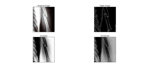 Bone Fracture Detection Opencv Qanda Forum