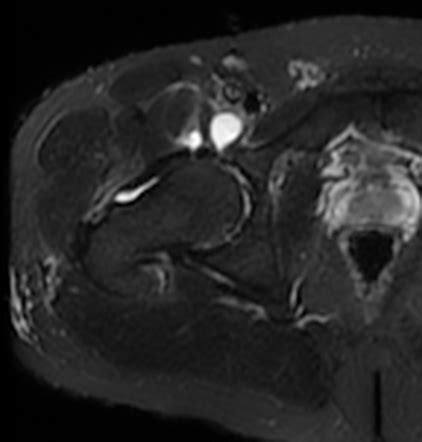 Iliopsoas Bursitis Or Iliopectineal Bursitiscauses