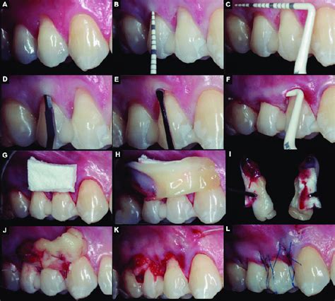 Representative Case Illustrating The Root Coverage Procedure Using The Download Scientific
