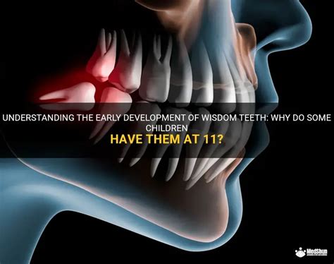 Understanding The Early Development Of Wisdom Teeth Why Do Some