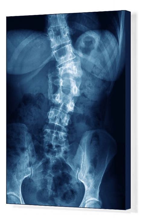 Broken Back X Ray Human