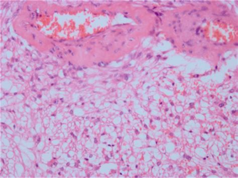 He Staining The Epithelioid Cells Are Diffuse Surrounded By A Great
