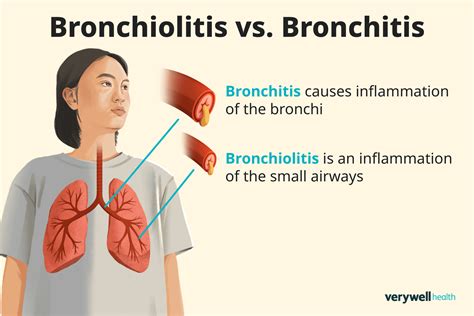 Bronchiolitis Vs Bronchitis