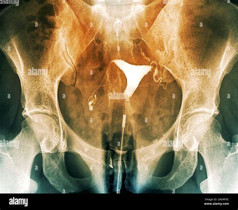 Coloured Hysterosalpingogram X Ray Of The Pelvis Of A Year Old Woman Showing Her Uterus Womb