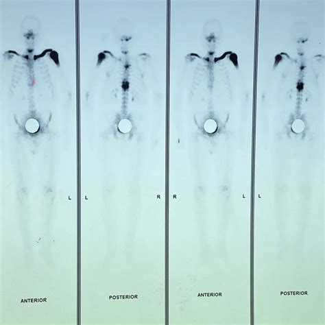 Technetium 99 M Bone Scan Demonstrated Increased Uptake At The Skull