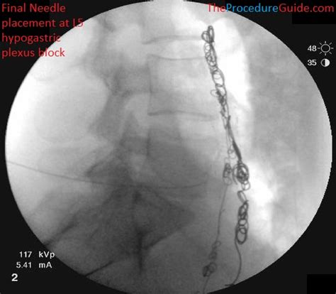 Hypogastric Plexus Block Technique And Overview The Procedure Guide