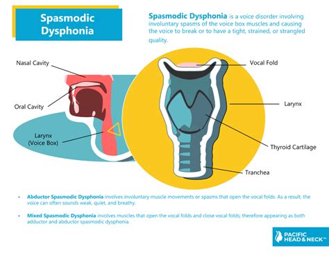 Spasmodic Dysphonia Pacific Head And Neck