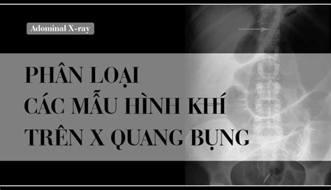 Phân Loại Các Mẫu Hình Khí Trên Phim X Quang Bụng Thường Quy Gas