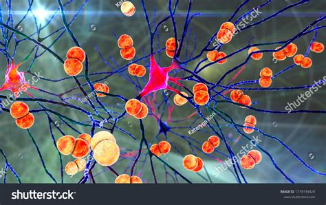 박테리아 스트렙토코커스 폐렴에 뉴런을 감염시키고 뇌세포를 스톡 일러스트 1779194429 Shutterstock