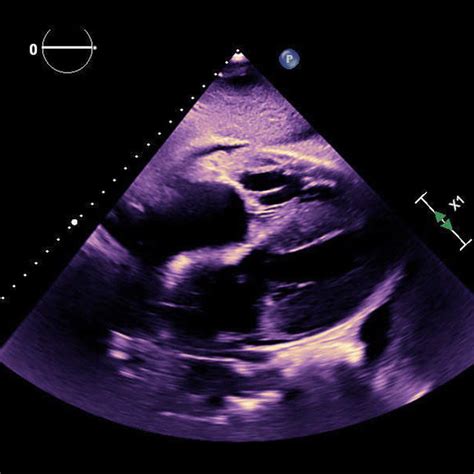 Pulse Wave Doppler Mitral Inflow Showing Restrictive Filling Pattern Download Scientific