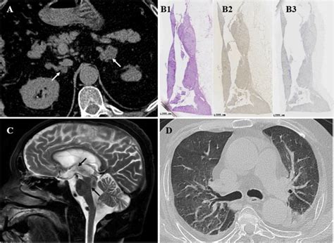 Imaging Features Of The Patients Adrenal Lesions And Cryptococcal Download Scientific Diagram