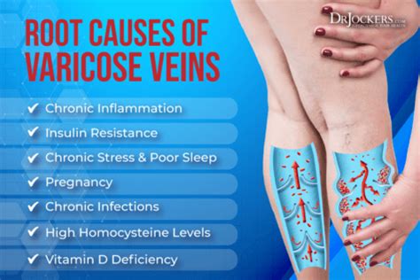 Varicose Veins Symptoms Causes And Natural Support Strategies