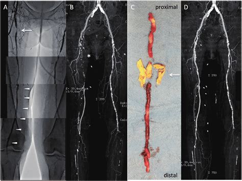 A Angiography Of Lower Extremity 3 Months Ago Revealed Short Segment