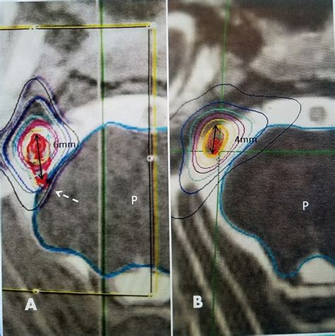 Evaluation Of Cyberknife Radiosurgery For Recurrent Trigeminal Neuralgia Pmc