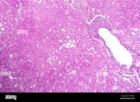 Photomicrograph Of Hepatic Steatosis Revealing Fat Accumulation In