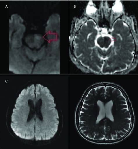 Diffusion Weighted Mri Scan A Download Scientific Diagram