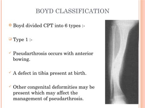 Congenital Pseudarthrosis Of Tibia Ppt
