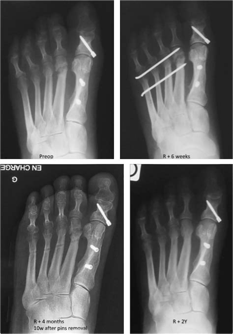 Minimally Invasive Lesser Metatarsal Osteotomies And Their Variations