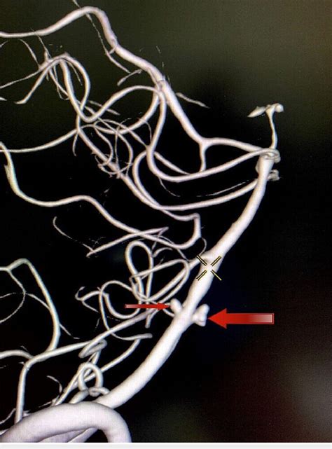 Dsa 3dra Lateral View Demonstrating Two Aneurysms The Left Arm Download Scientific Diagram